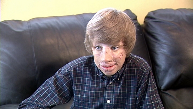 Burn victim's recovery, resilience inspiring those around him | KSL.com