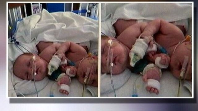 Conjoined boys separated at Dallas hospital | KSL.com
