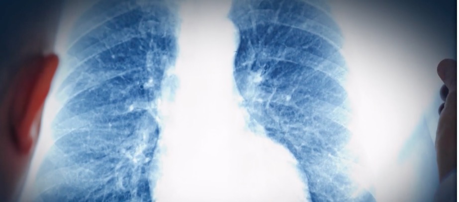 New drugs slows scarring of the lungs due to pulmonary fibrosis | KSL.com