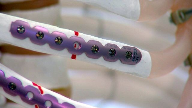 New 'rib plating' procedure helps patients of broken ribs | KSL.com