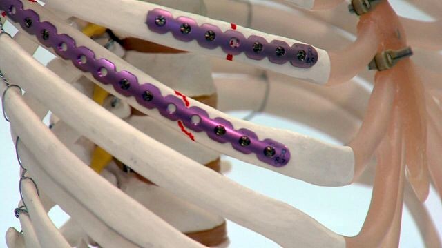 New 'rib plating' procedure helps patients of broken ribs | KSL.com
