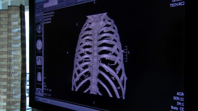 New 'rib plating' procedure helps patients of broken ribs | KSL.com