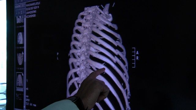 New 'rib plating' procedure helps patients of broken ribs | KSL.com