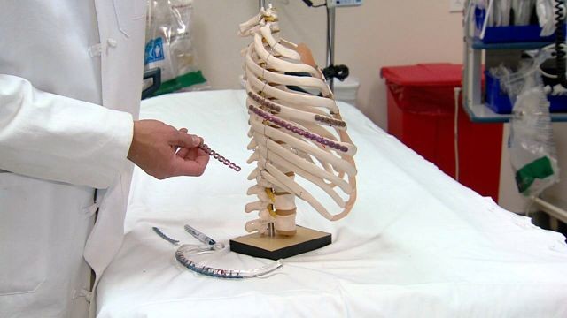 New 'rib plating' procedure helps patients of broken ribs | KSL.com